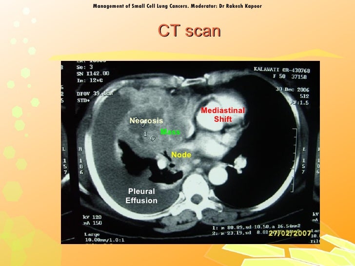 Loculated Pleural Effusion Ct Scan Cureus A Case Of Transudative