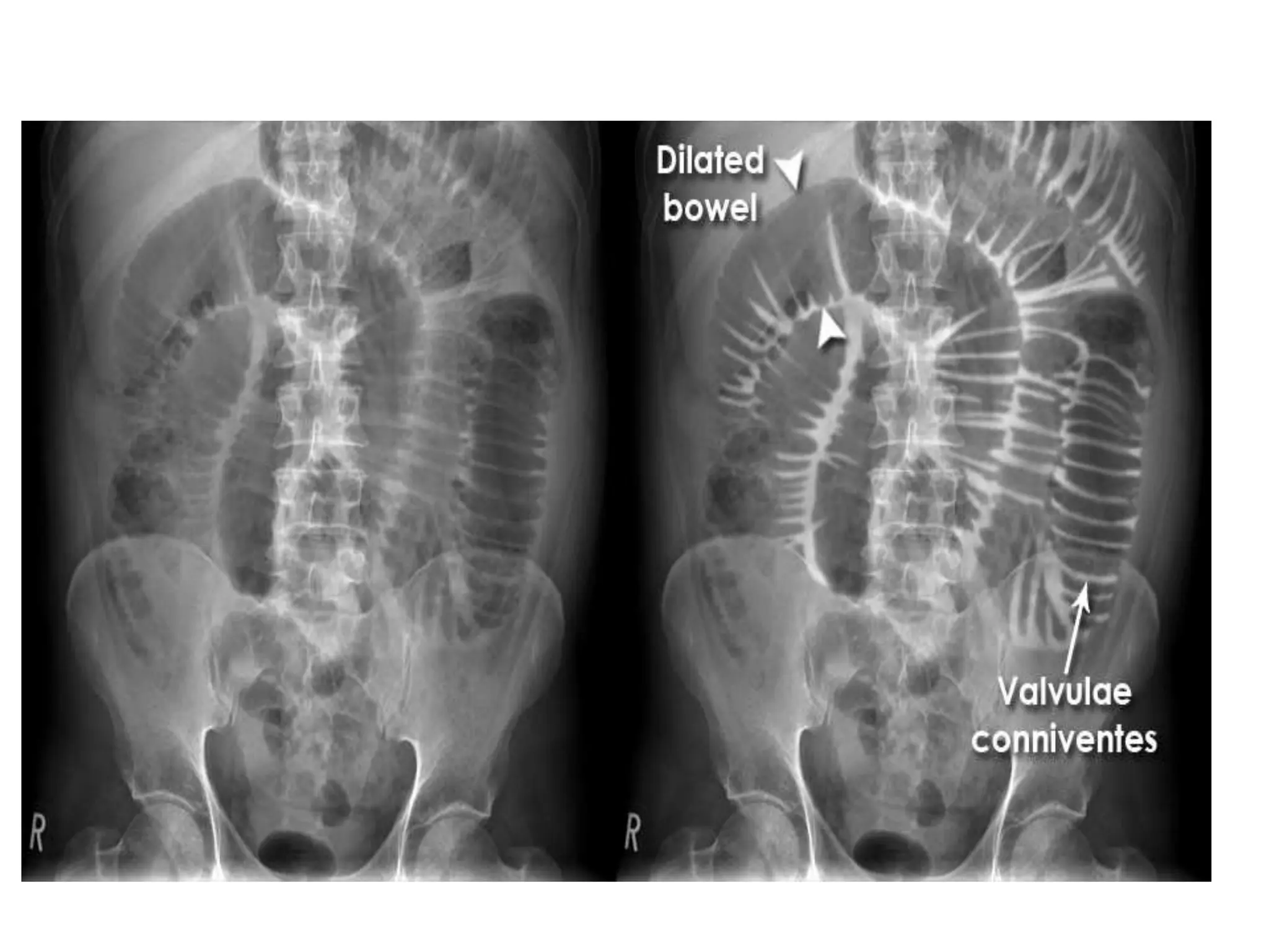 Anatomy of small and large Bowel PPT.pptx