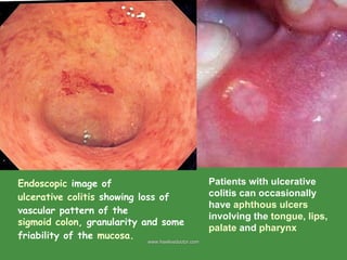 Small and large intestine pathology | PPT