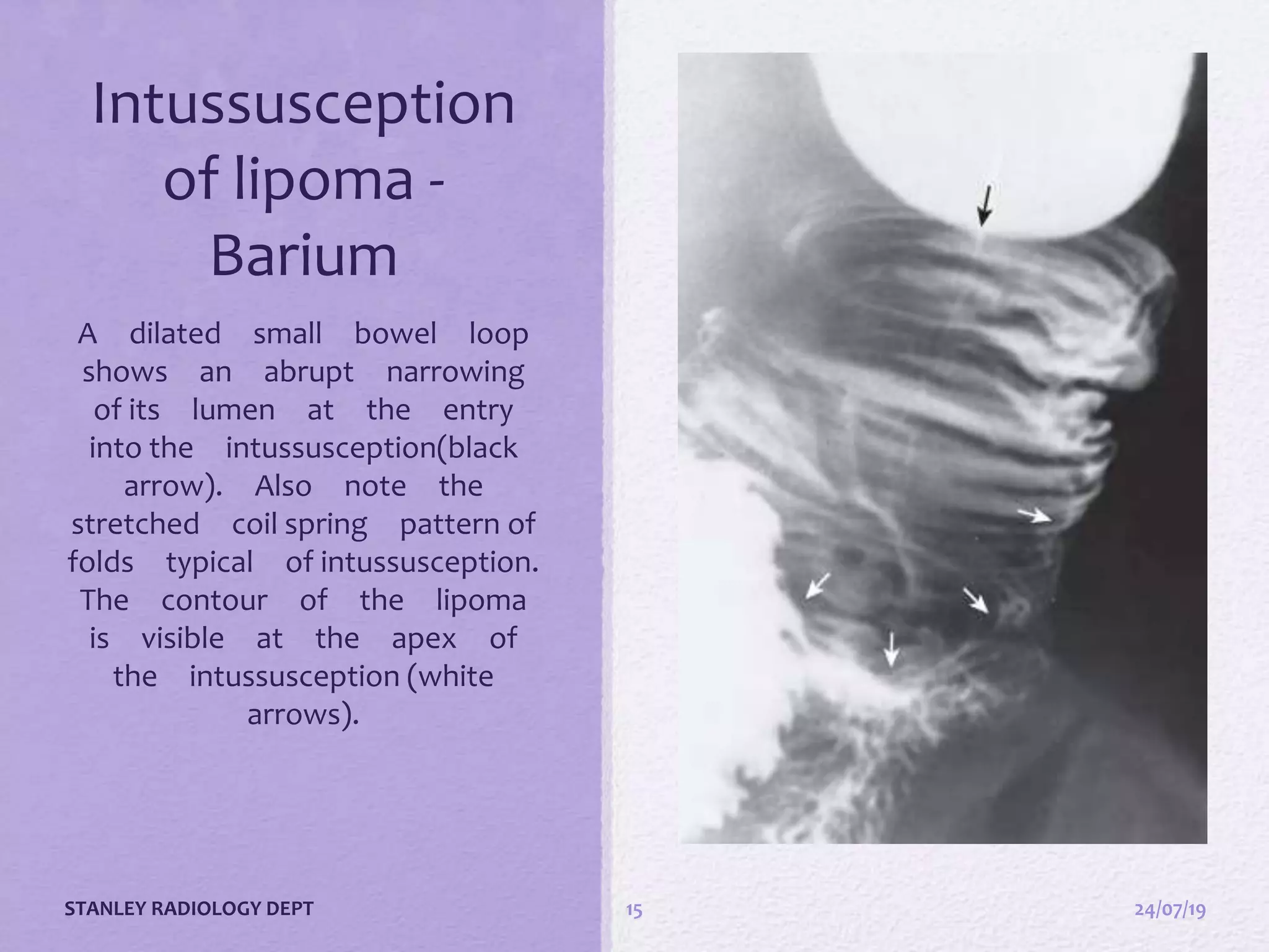 Small bowel neoplasms | PPTX