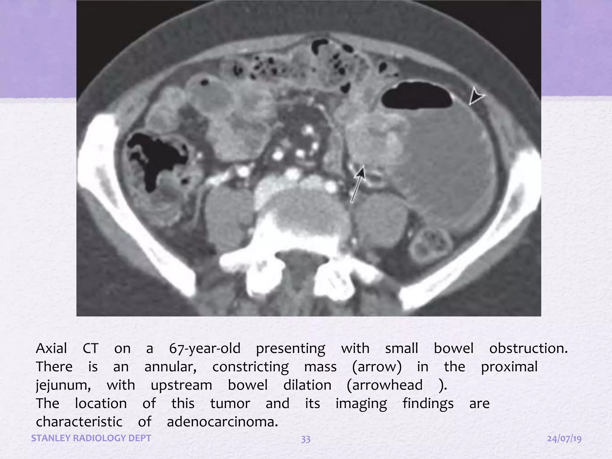 Small bowel neoplasms | PPTX