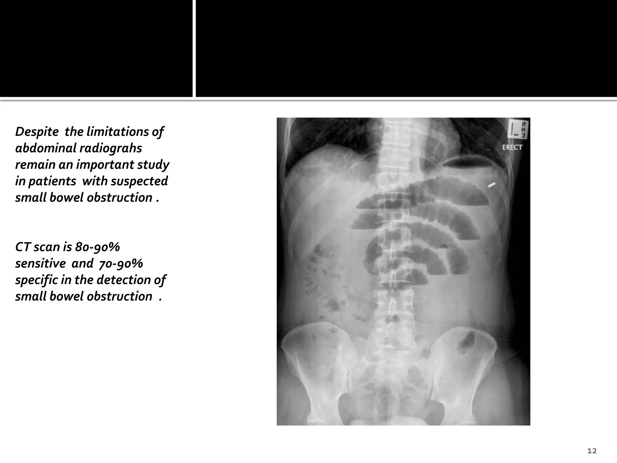 Small bowel obstruction | PPTX