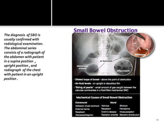 Small bowel obstruction | PPTX