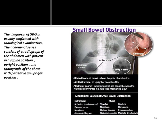 Small bowel obstruction | PPTX