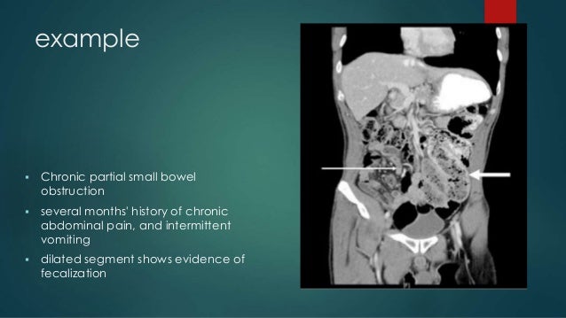 Small bowel obstruction