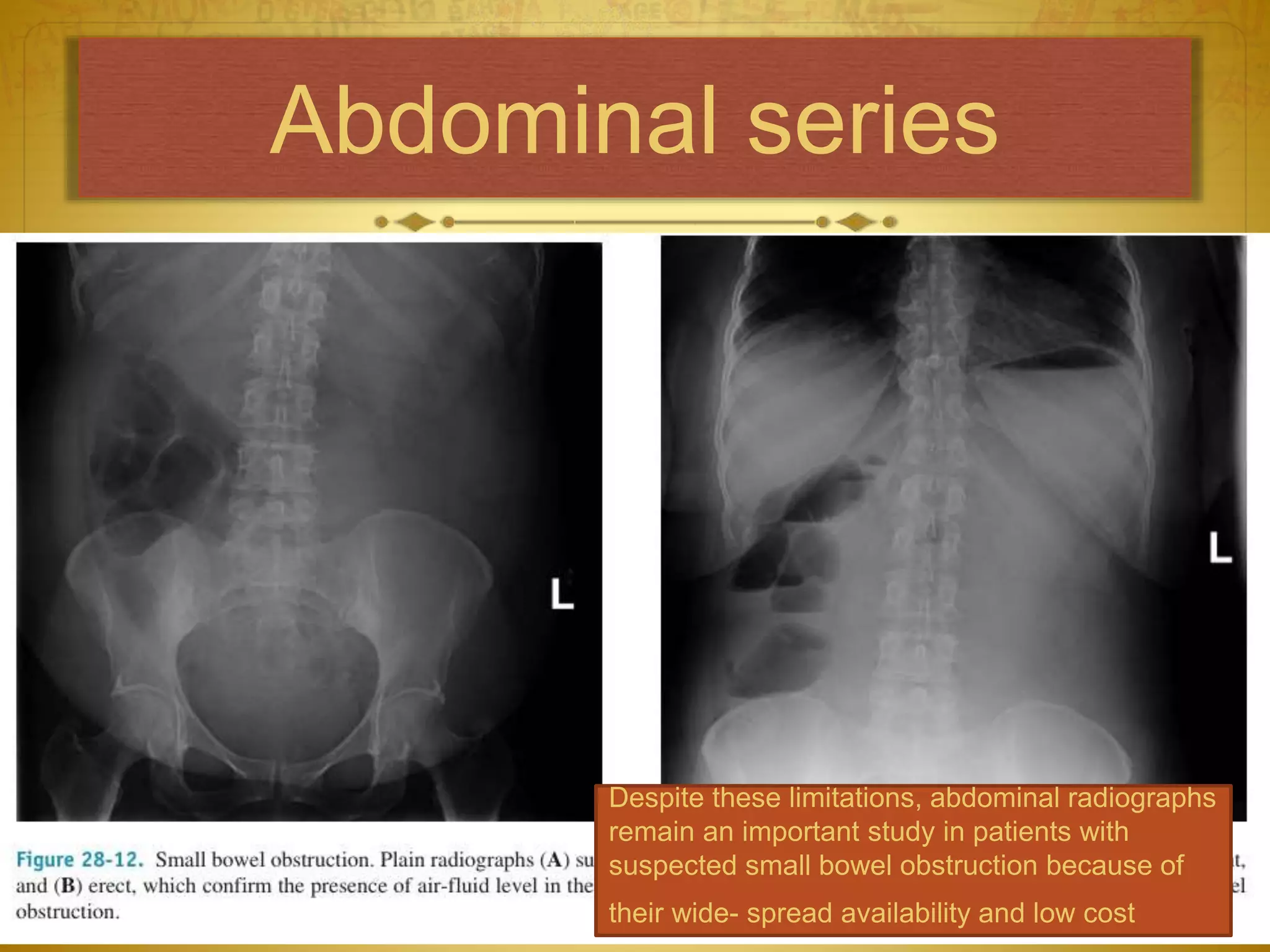 Small bowel obstruction and Intestinal Fistulas | PPTX | Digestive ...