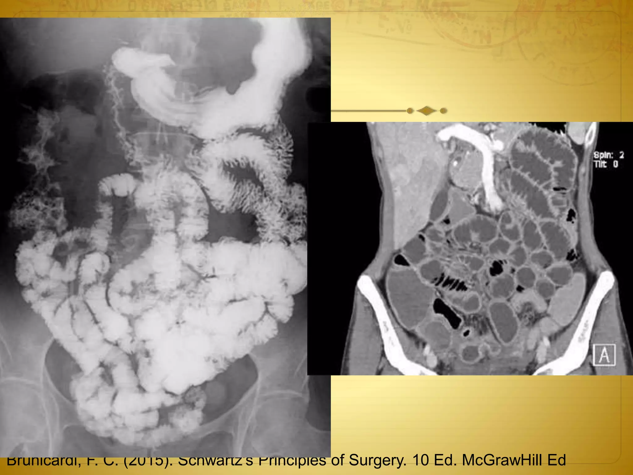 Small bowel obstruction and Intestinal Fistulas | PPTX | Digestive ...