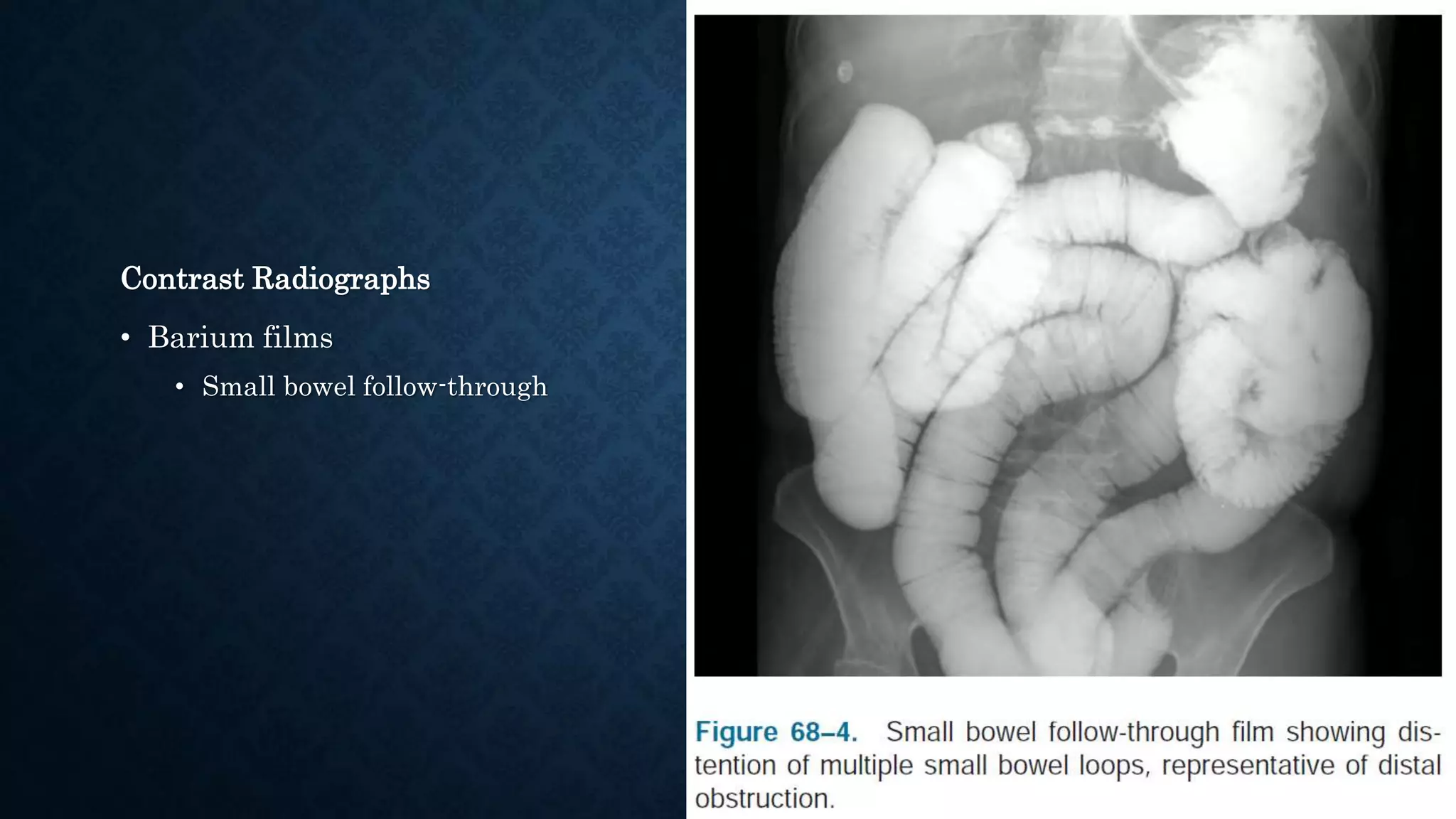 Small bowel obstruction | PPTX
