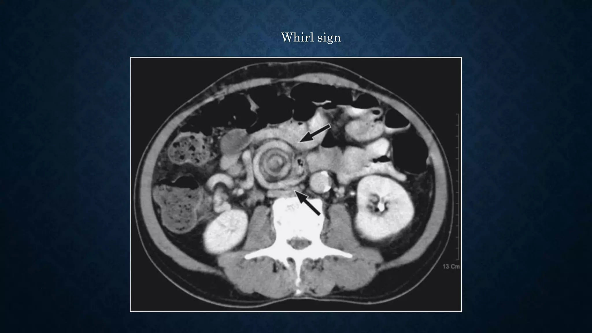 Small bowel obstruction | PPTX