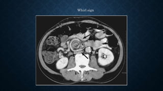 Small bowel obstruction | PPTX