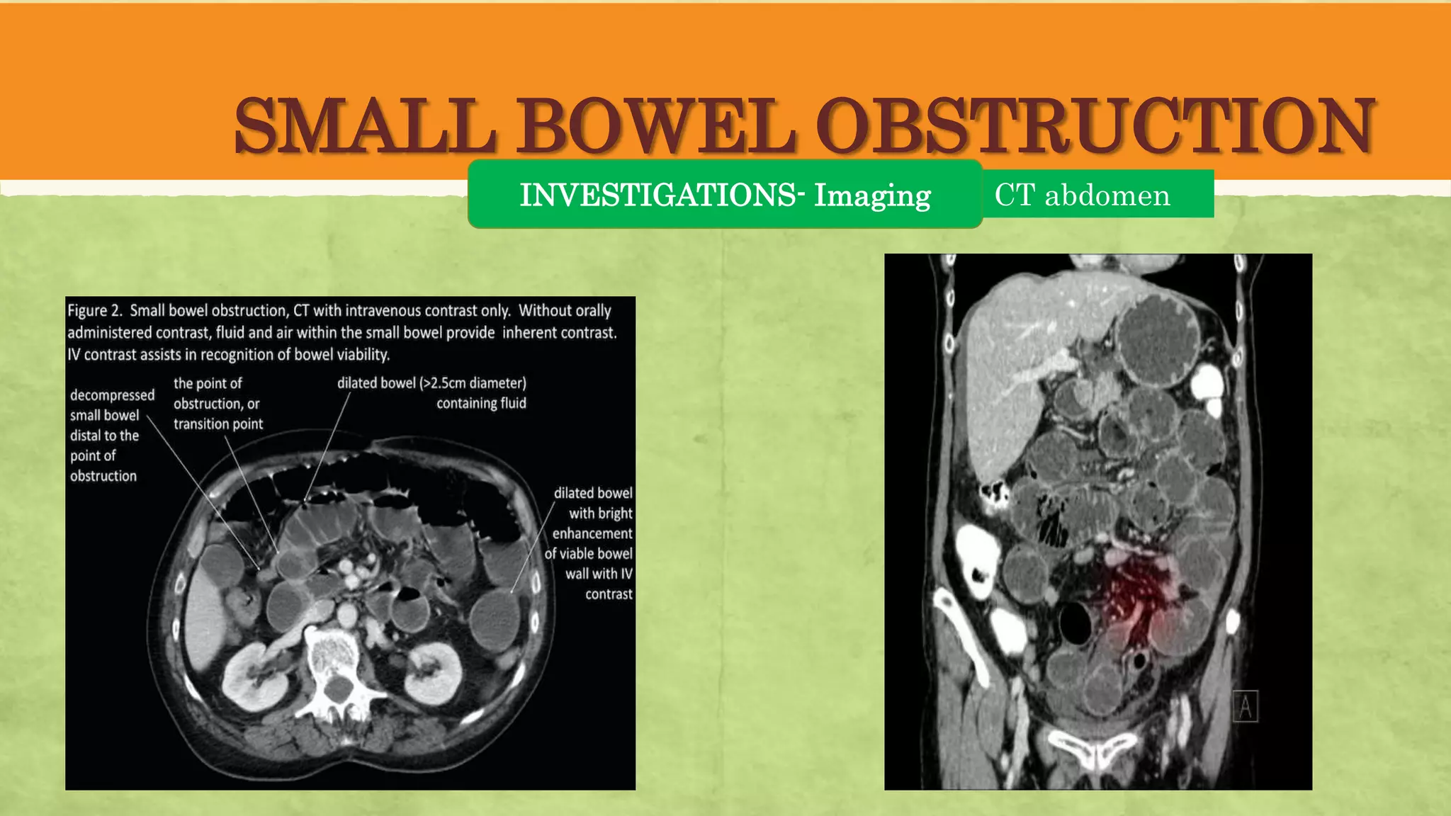Small bowel obstruction/ Generalised abdominal pain | PPTX