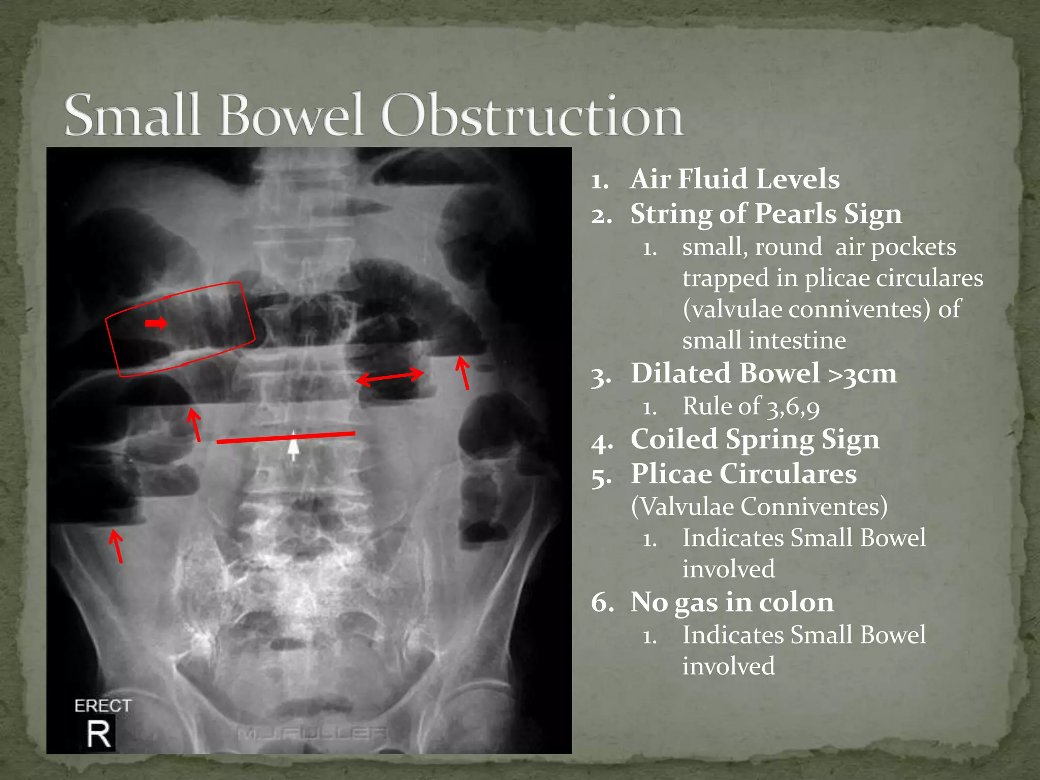 Small bowel obstruction (1) | PPTX