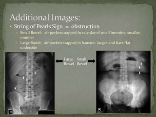 Small bowel obstruction Power Point | PPTX