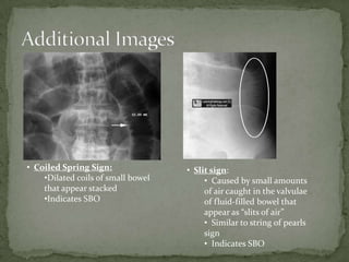 Small bowel obstruction Power Point | PPTX
