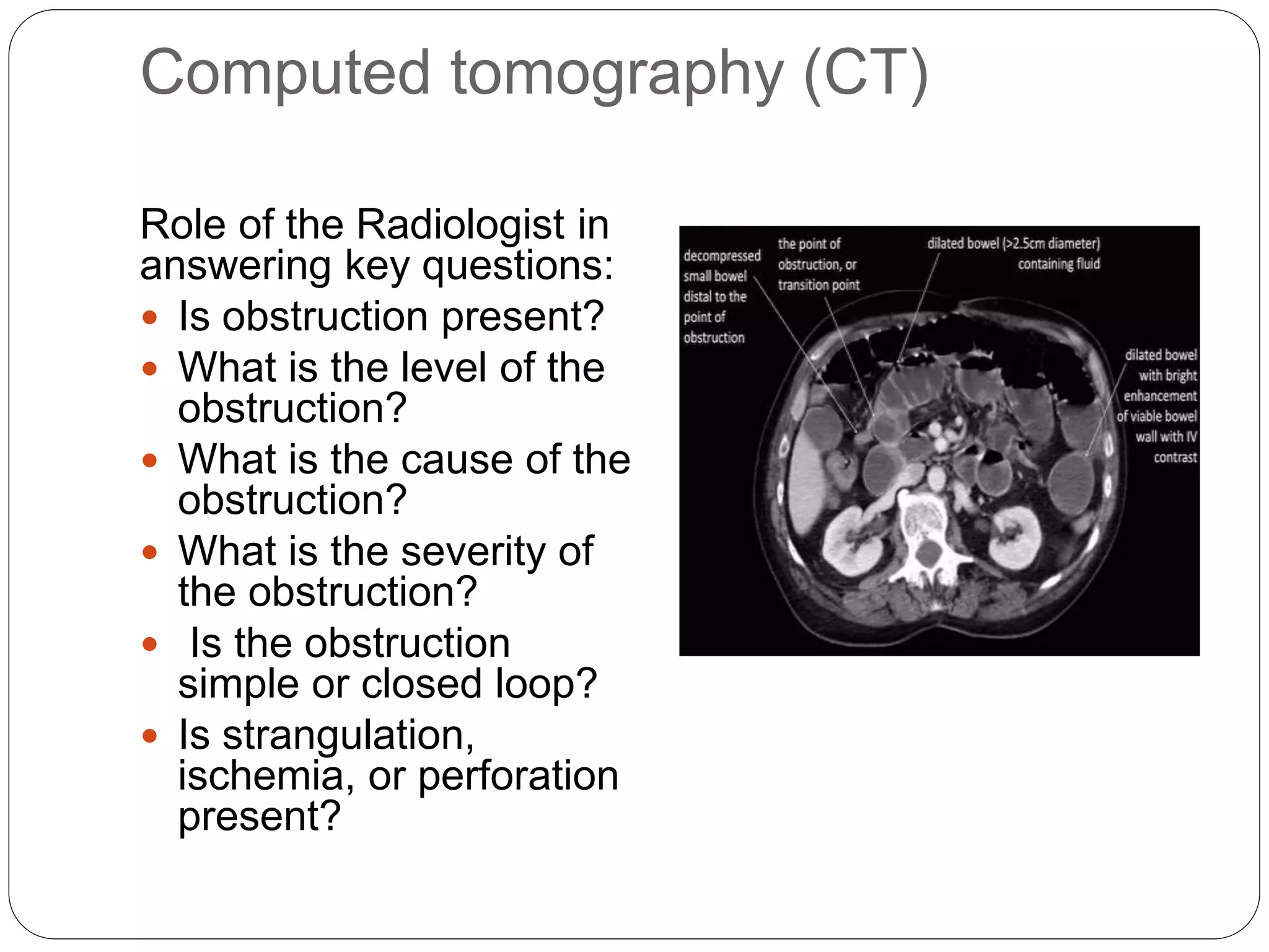 Small Bowel obstruction presentation.pptx