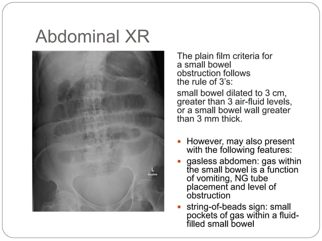 Small Bowel obstruction presentation.pptx | Digestive Disorders ...