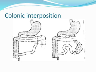 Short bowel syndrome | PPT