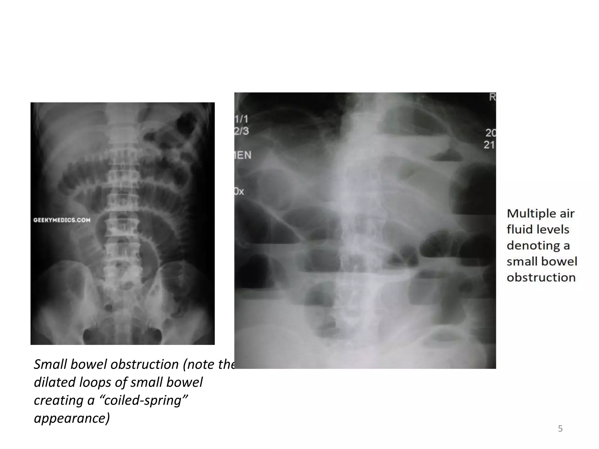 Small bowel vs large.pptx