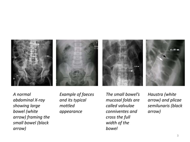 Small bowel vs large.pptx | Digestive Disorders | Diseases and Conditions