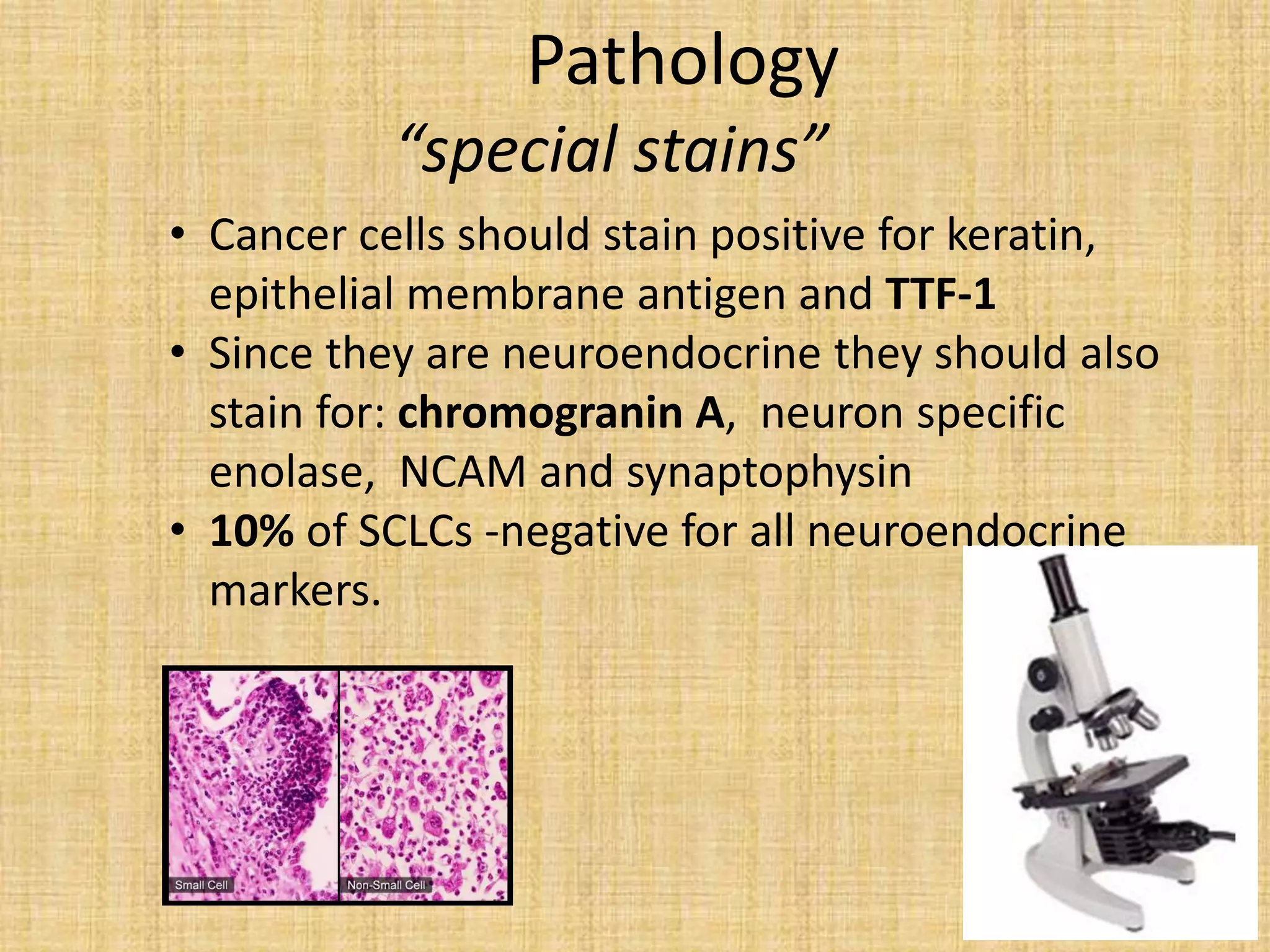 Small cell lung cancer | PPTX | Cancer | Diseases and Conditions