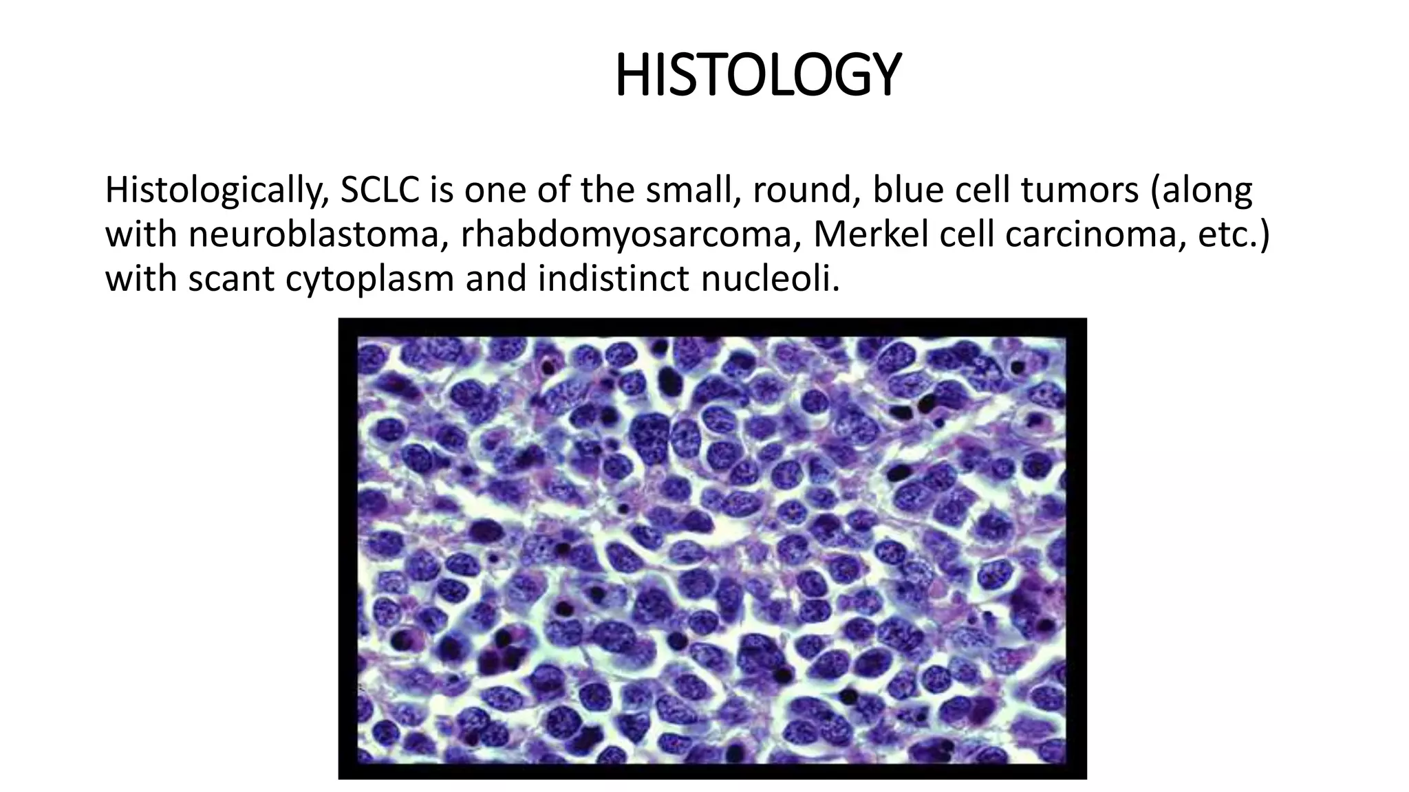 Small cell lung cancer | PPTX