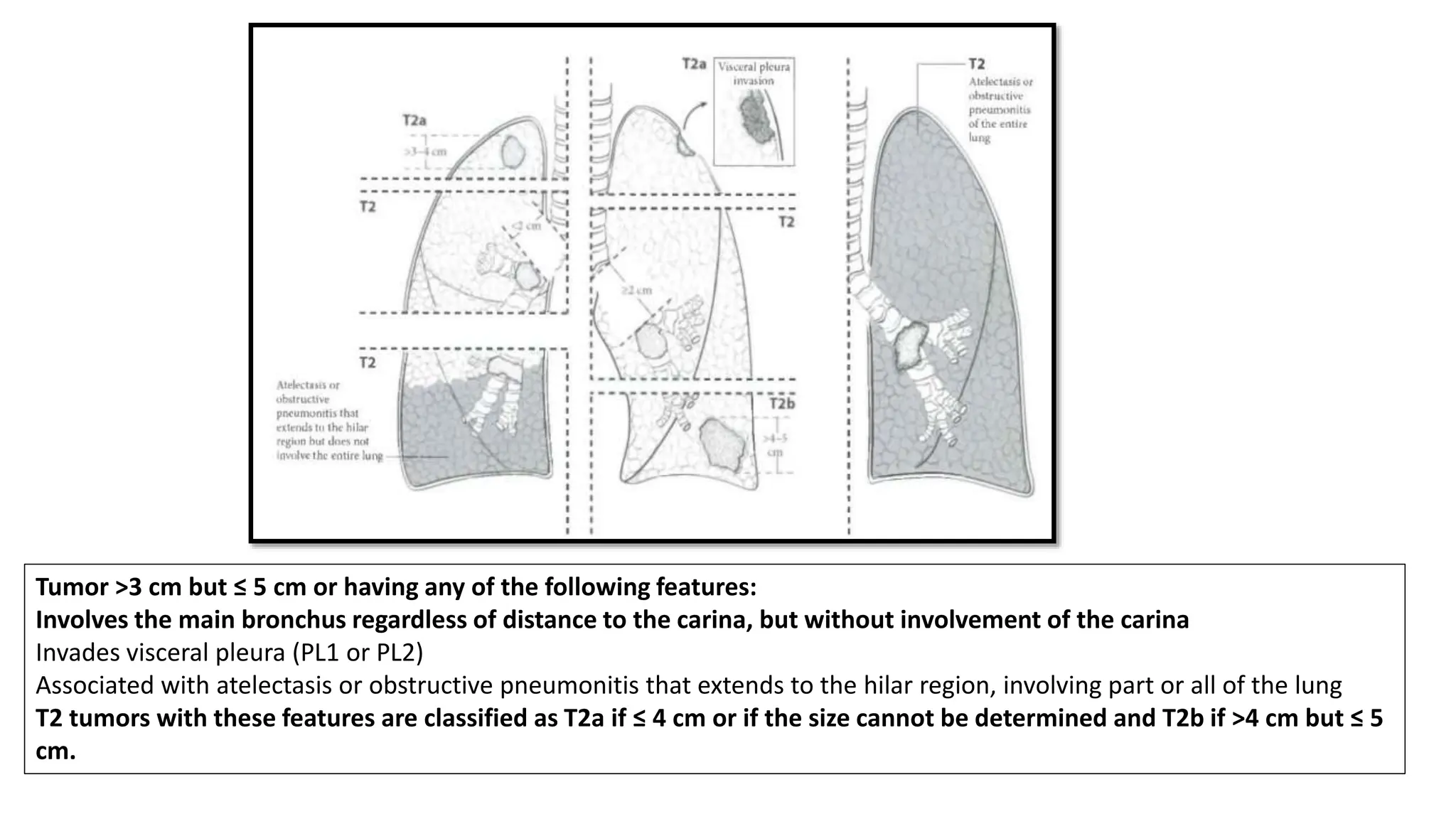 Small cell lung carcinoma anatomy to management | PPT