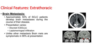 Small cell lung carcinoma anatomy to management | PPTX