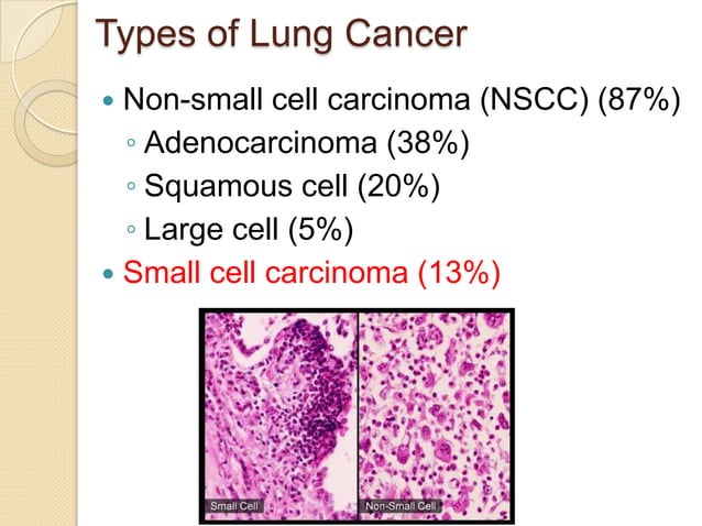 Small Cell Lung Cancer