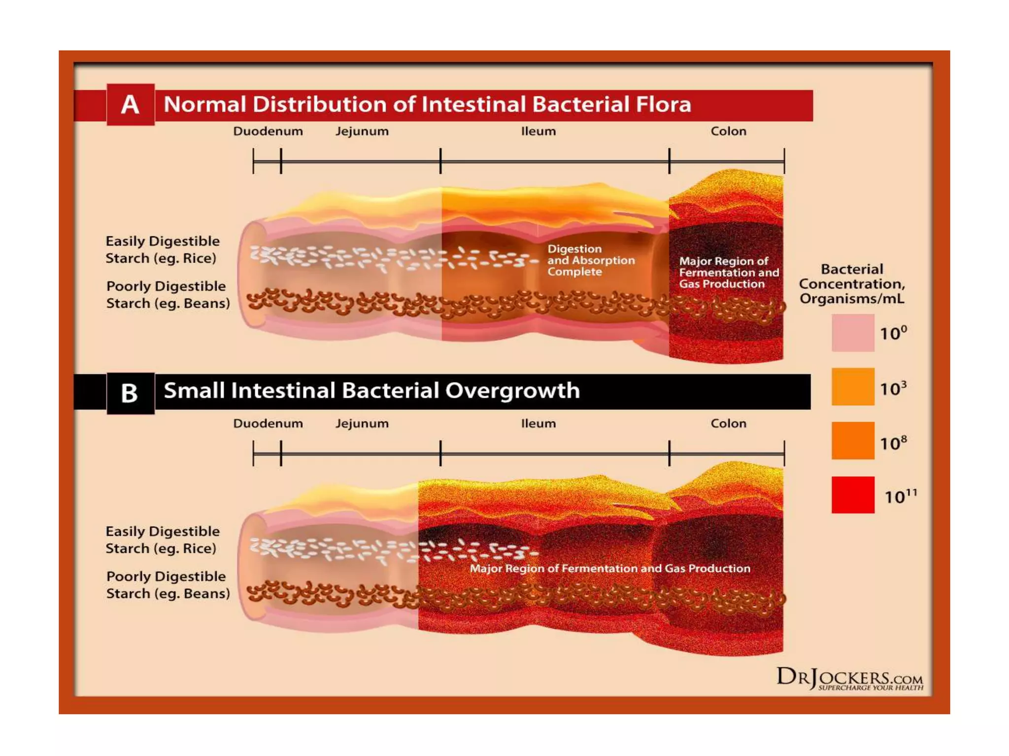 Small intestinal bacterial overgrowth (SIBO) | PPTX