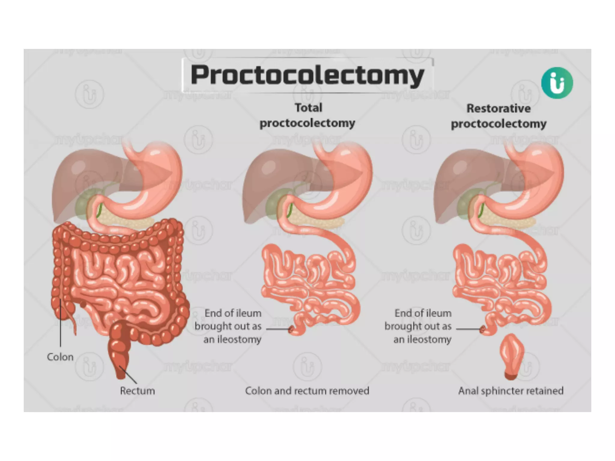 Small intestinal inflammation and infection | PPT