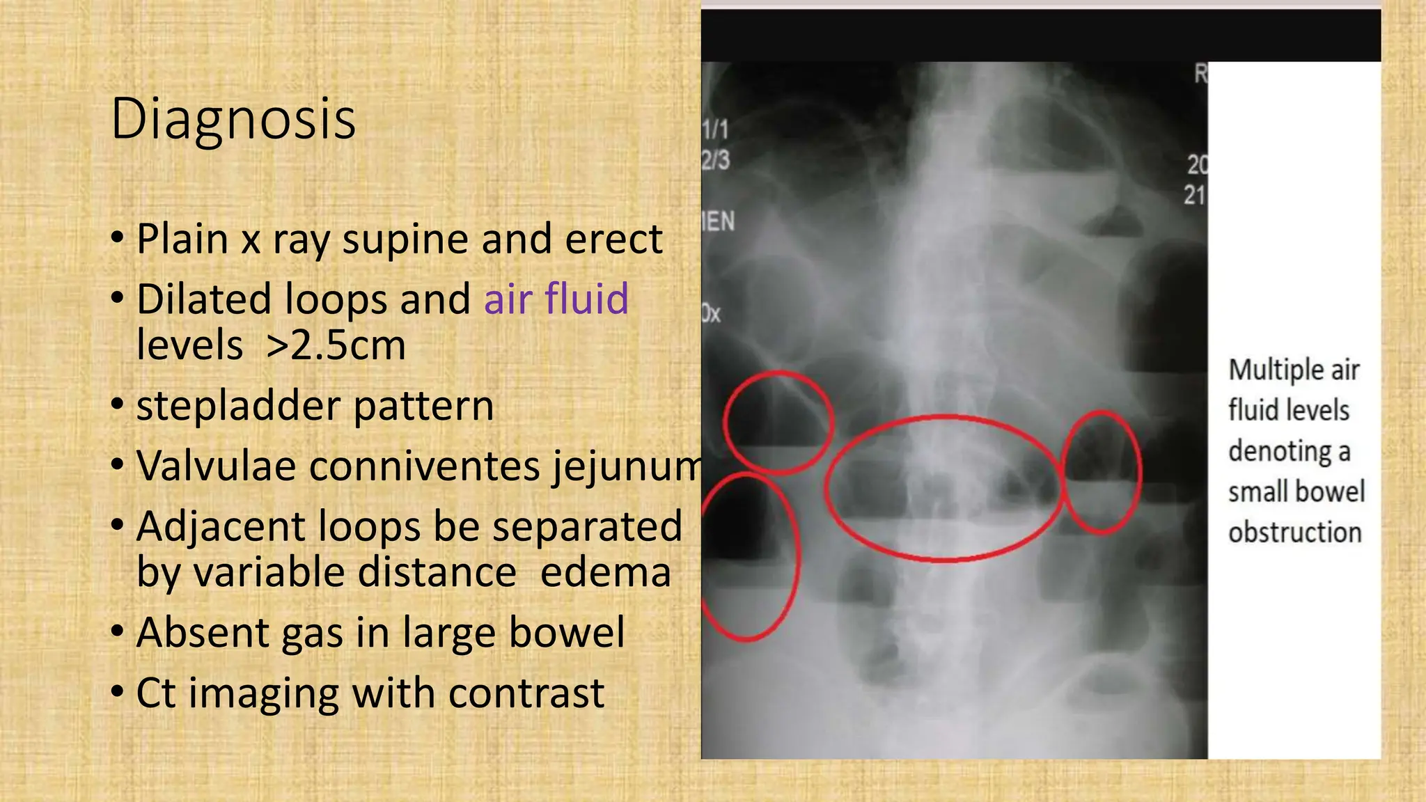 SMALL INTESTINAL OBSTRUCTION.pptx