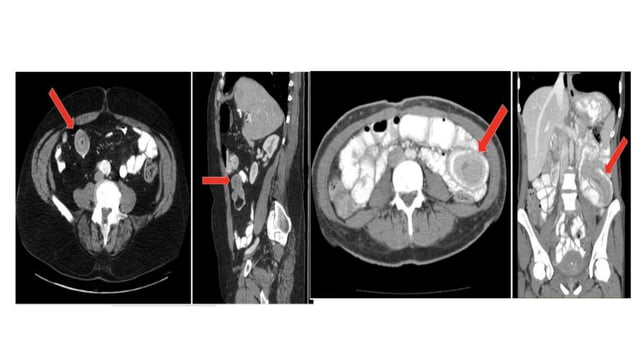Small intestine/Intestinal obstruction/crohns disease/ileostomy/viscous ...
