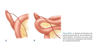 Small intestine/Intestinal obstruction/crohns disease/ileostomy/viscous ...