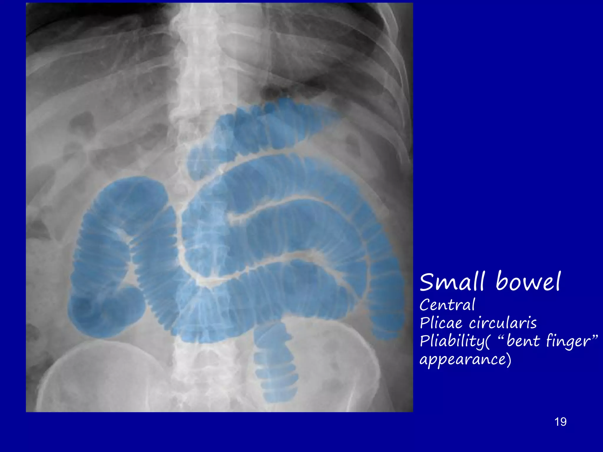 radiological anatomy of Small intestine abdul final | PDF