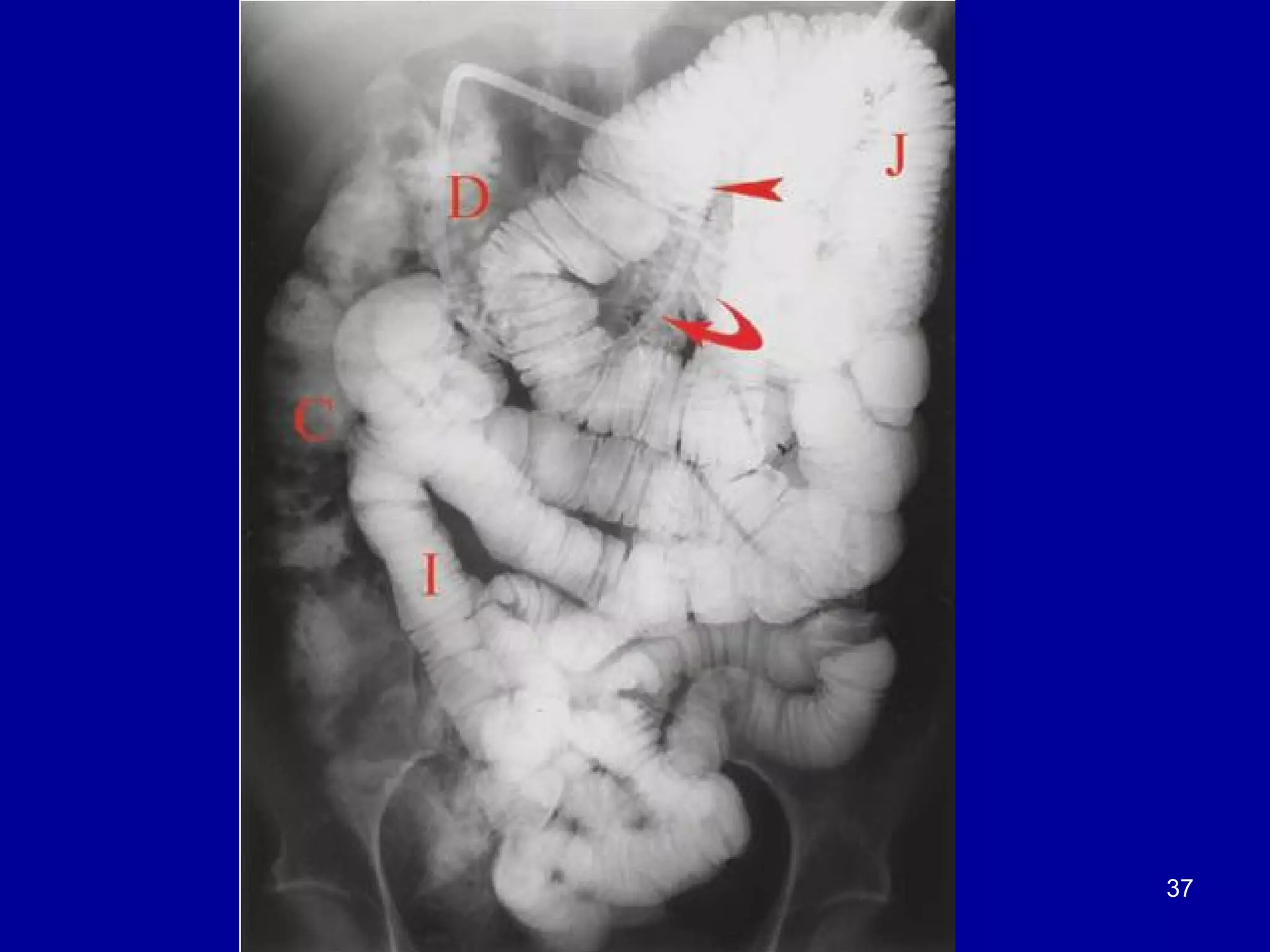 radiological anatomy of Small intestine abdul final | PDF