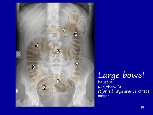 radiological anatomy of Small intestine abdul final | PPT