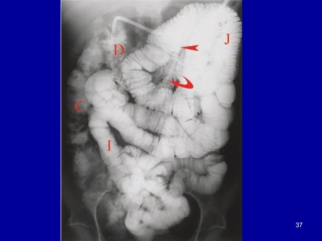 radiological anatomy of Small intestine abdul final | PPT