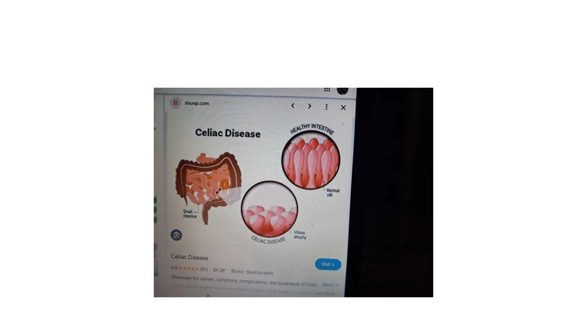 Small Intestine_disorders-causes_symptoms.pptx