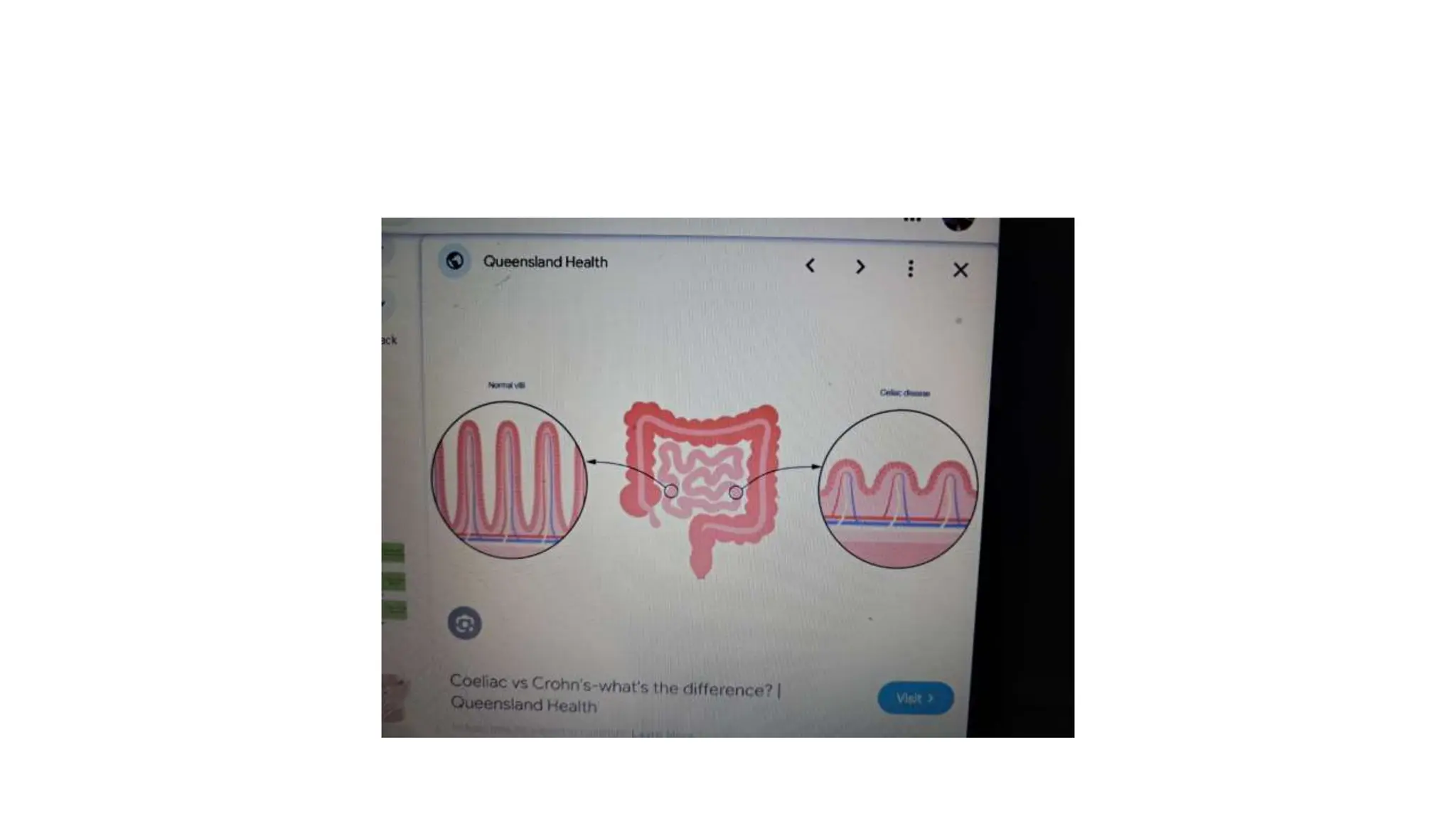 Small Intestine_disorders-causes_symptoms.pptx