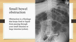 Small intestine surgery | PPTX