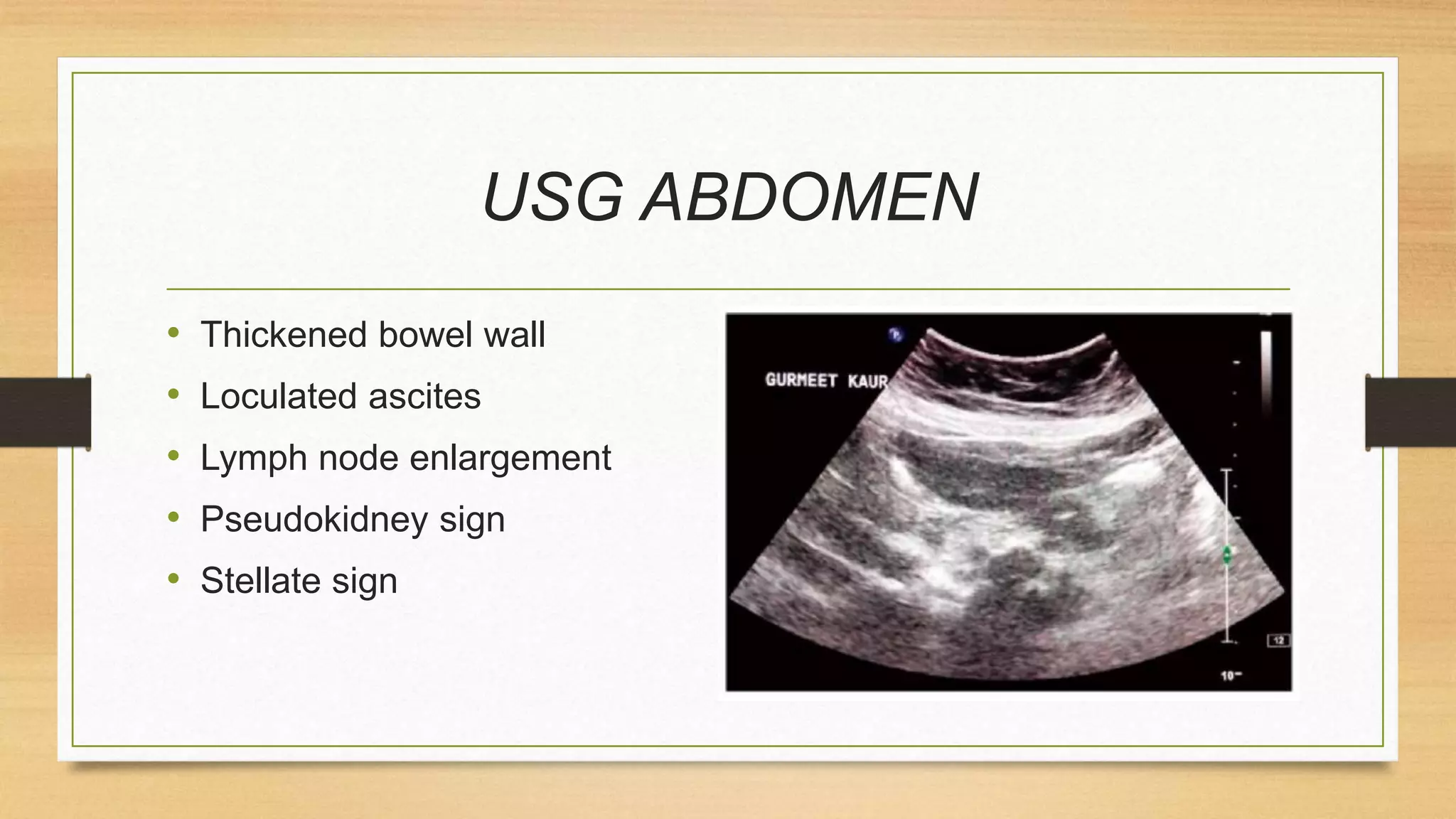 Small Intestine TB (Tuberculosis) | PPTX