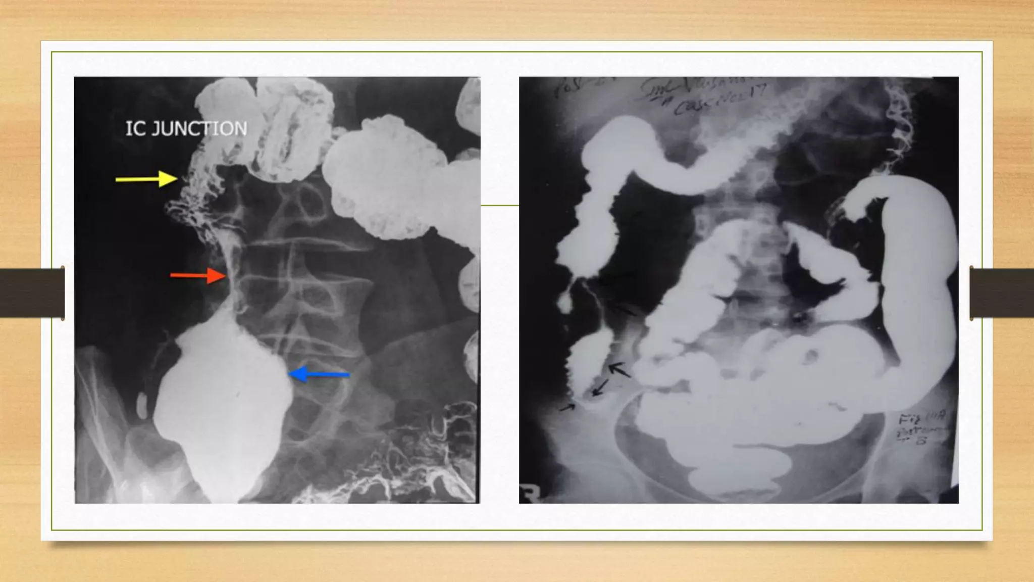 Small Intestine TB (Tuberculosis) | PPTX