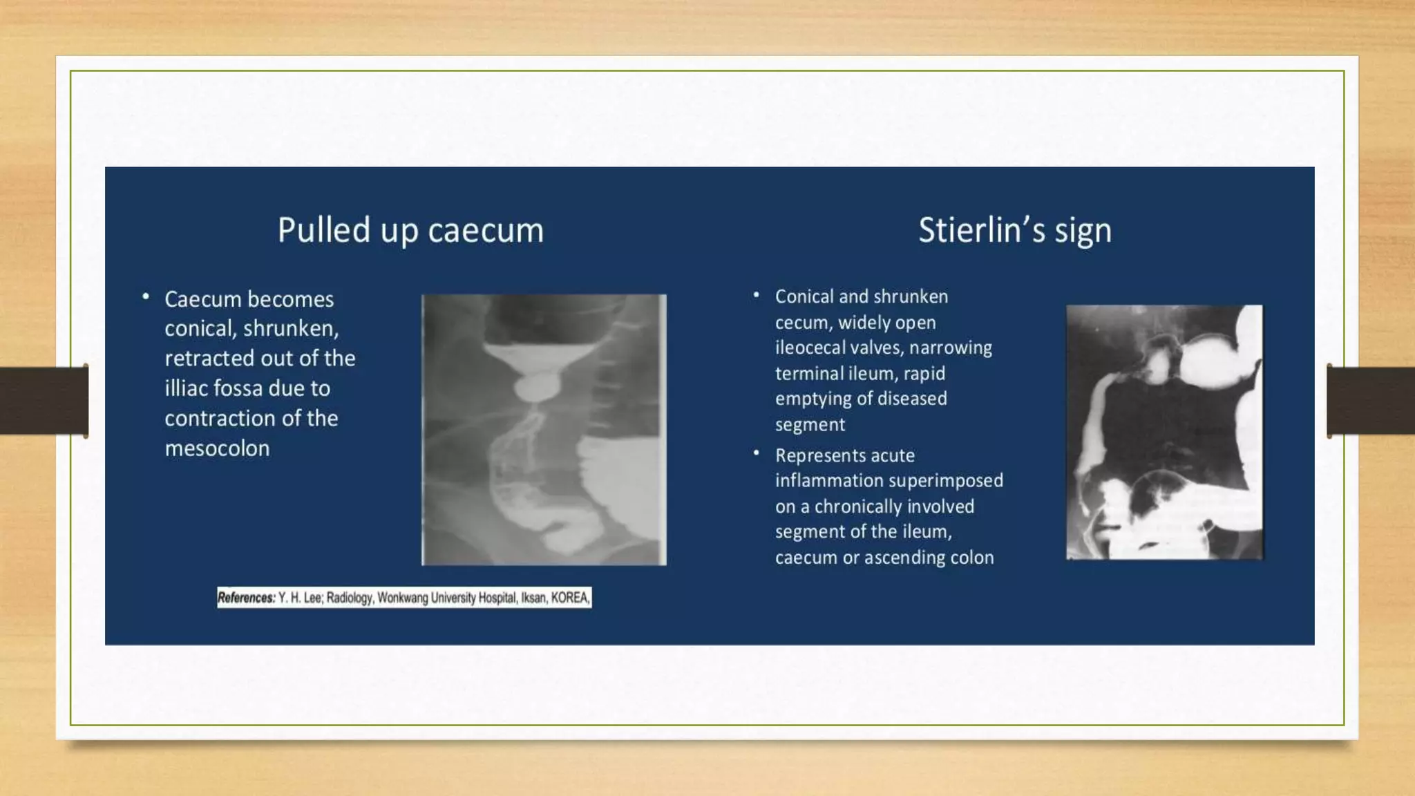 Small Intestine TB (Tuberculosis) | PPTX