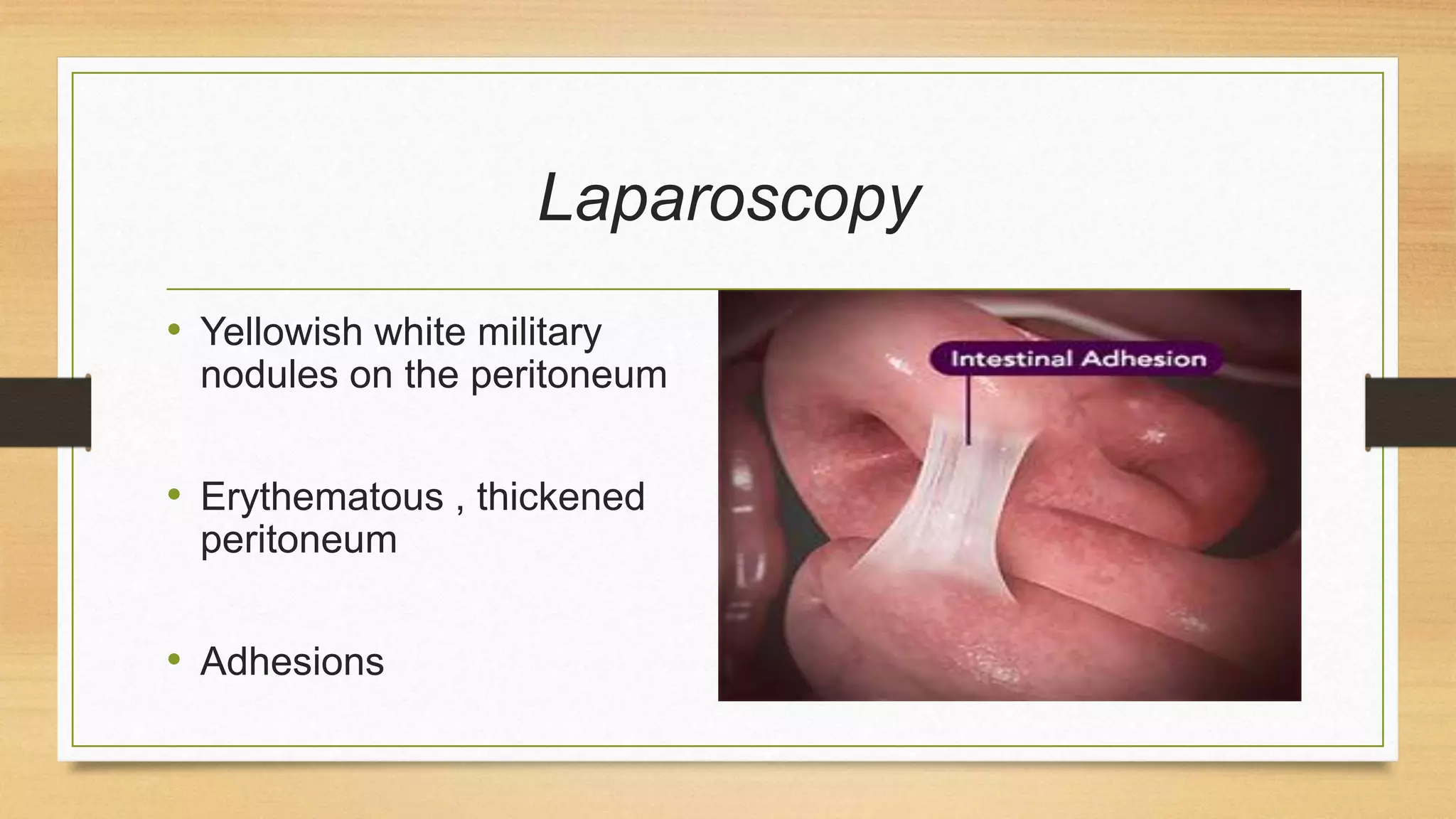 Small Intestine TB (Tuberculosis) | PPTX