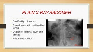 Small Intestine TB (Tuberculosis) | PPTX