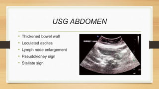 Small Intestine TB (Tuberculosis) | PPTX