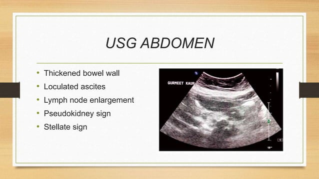 Small Intestine TB (Tuberculosis) | PPTX | Digestive Disorders ...