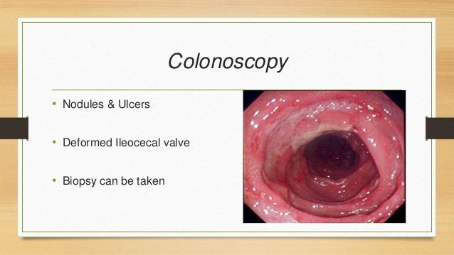 Small Intestine TB (Tuberculosis)