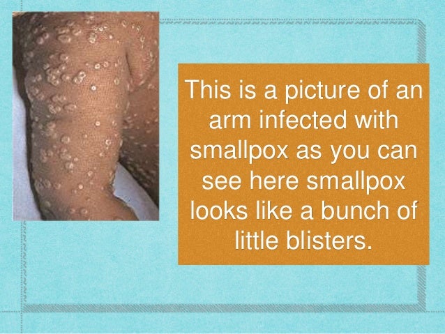 Smallpox