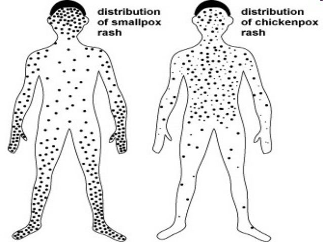 SMALL POX A DEAD DISEASE